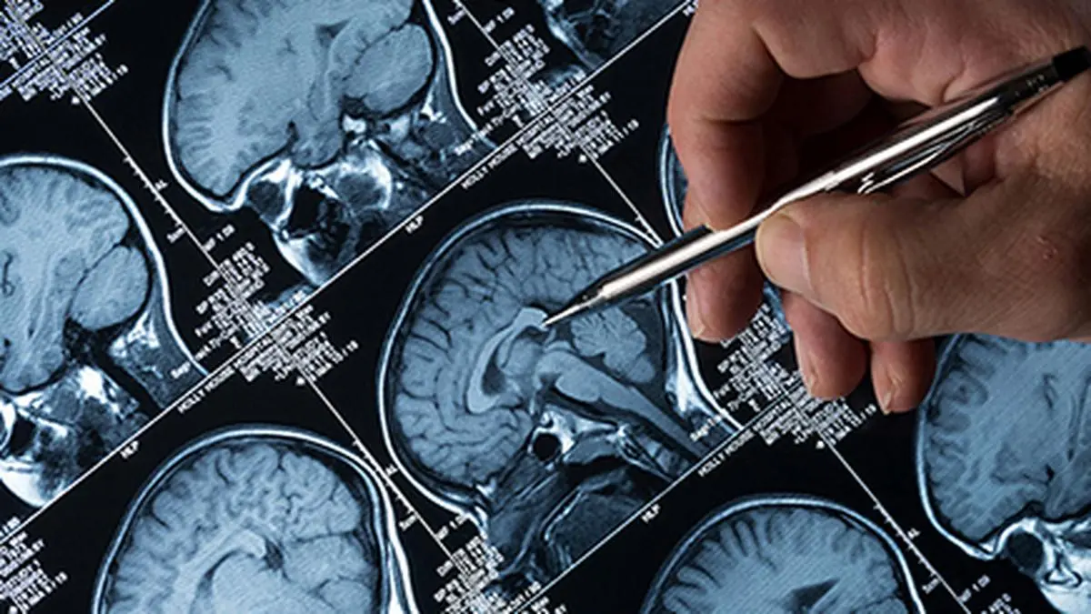 Science Notebook | Brain Scans to Detect Dementia; Search for New ...